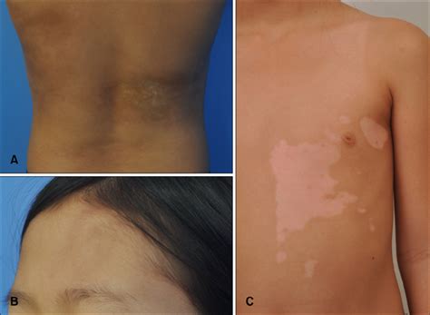 Linear Scleroderma