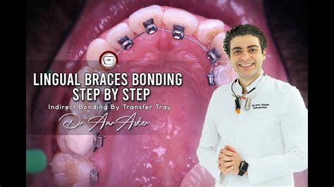 Lingual Braces Bonding Step By Step Indirect Bonding By Transfer Tray