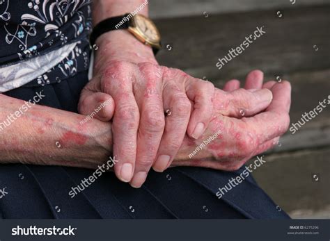 Skin Rashes Old Woman Images Stock Photos Vectors Shutterstock