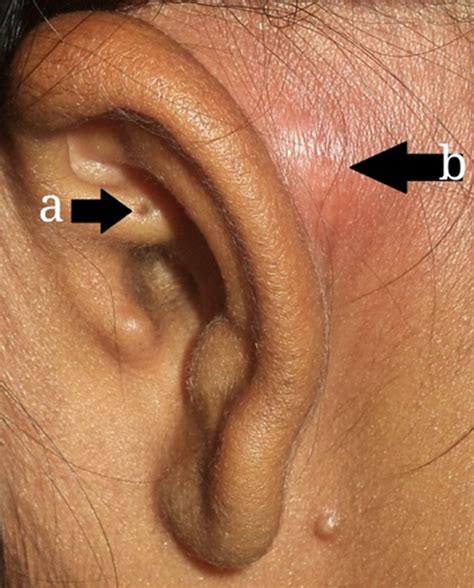Pre Auricular Sinus With Post Auricular Extension An Uncommon Variant