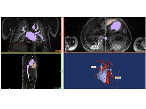 Pulmonary Sequestration 3d Life