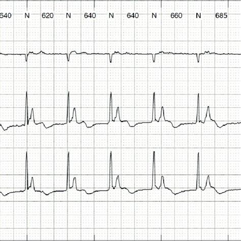 Heart Rate Unmasking After Decrease Heart Rate Download Scientific Diagram