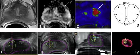 Reduced Core Targeted Rct Biopsy Combining Multiparametric Magnetic Resonance Imaging