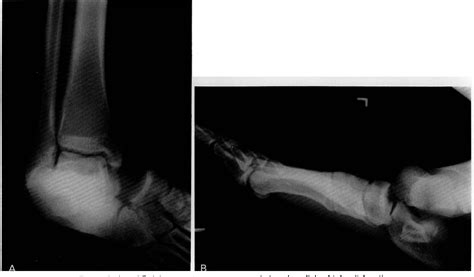 Figure 3 From Medial Subtalar Dislocation In An Athlete Semantic Scholar