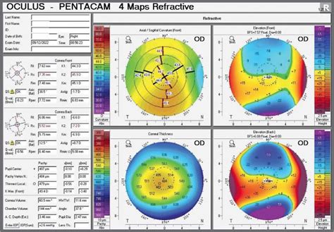 Choosing Candidates For Topography Guided Custom Ablation Treatment