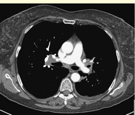 10a Cross Sectional Ct Scan Of The Thorax Showing A Station
