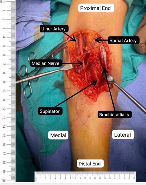 Decompressed Median Nerve After Release Of All The Potential Download Scientific Diagram