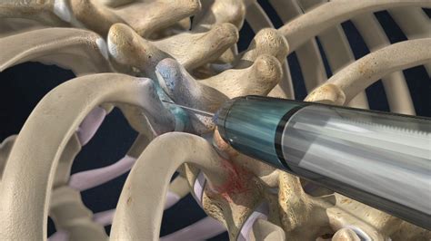 Zapata Milan Costovertebral Joint Costovertebral Joint Involvement In