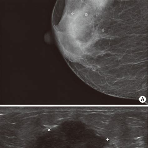 Breast Imagings A Mammography Shows Ill Defined Lobulating And Download Scientific Diagram