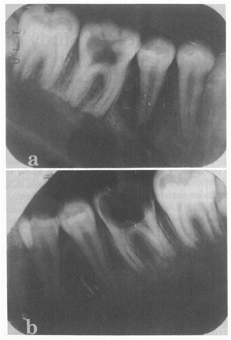 Radiographs Illustrating Bilateral Occurrence Of Three Rooted Download Scientific Diagram