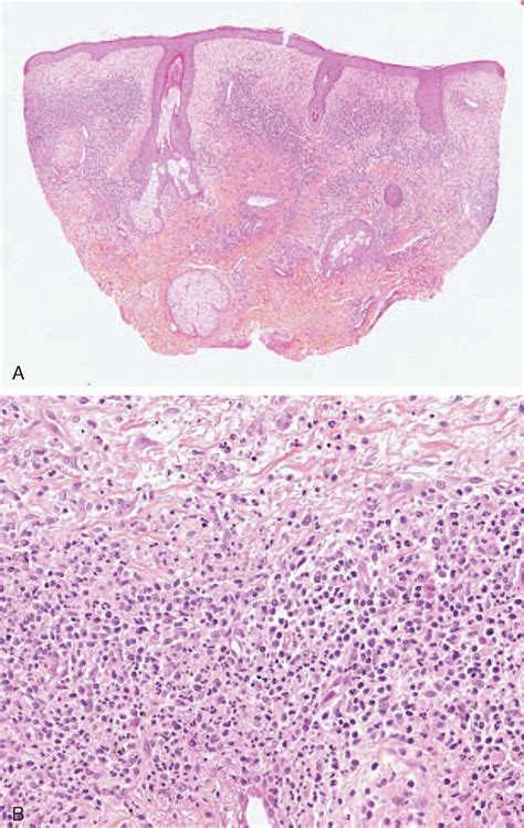 A Dense Dermal Polymorphic Infiltrate Composed Primarily Of Download Scientific Diagram
