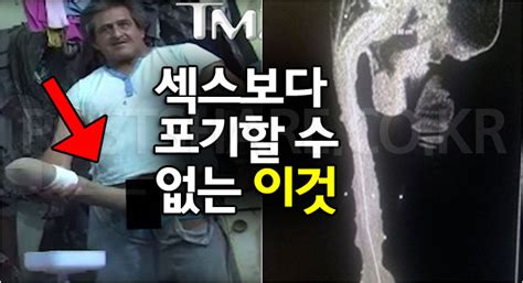 세계에서 성기가 가장 큰 남성에게 축소수술 제의가 들어왔다 하지만 포스트쉐어