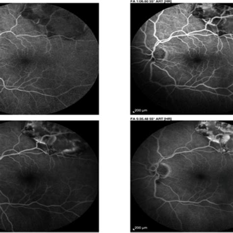 Pdf Sclerochoroidal Calcification Associated With Chondrocalcinosis A Clinical Case