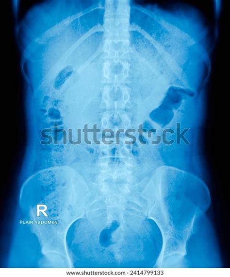 Fecal Loading Photos Images And Pictures Shutterstock
