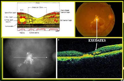 MACULAR OCT Optometry Education