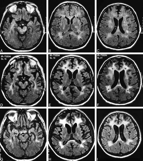 Hiv Encephalitis Symptoms