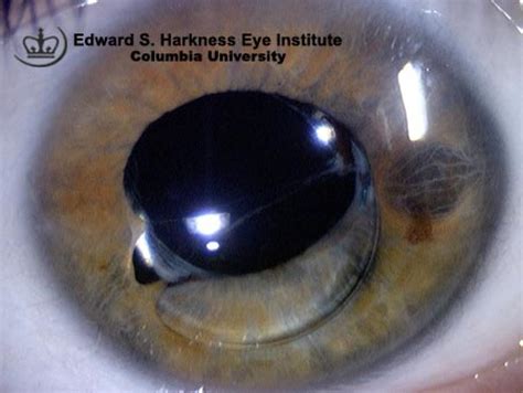 Pupillary Block Vagelos College Of Physicians And Surgeons