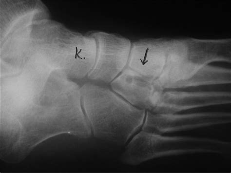X Ray Of Foot Oblique View Showing Irregular Osteolytic Lesions Of Download Scientific