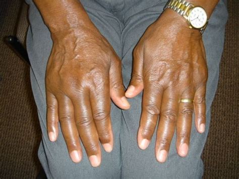 Rheumatoid Arthritis Eular 2024 Rheumnow