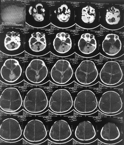 Ct Scan Image Of Brain Download Scientific Diagram