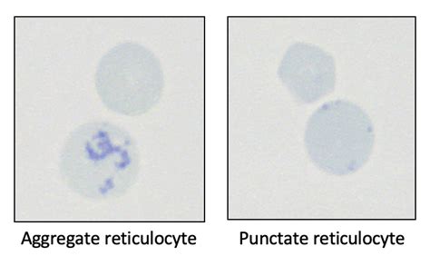 Reticulocytes Clinical Pathology And Hemolymphatics