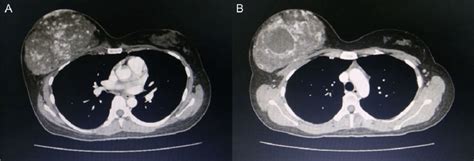 Computed Tomography Of The Chest Revealed A Hypervascular Mass In The