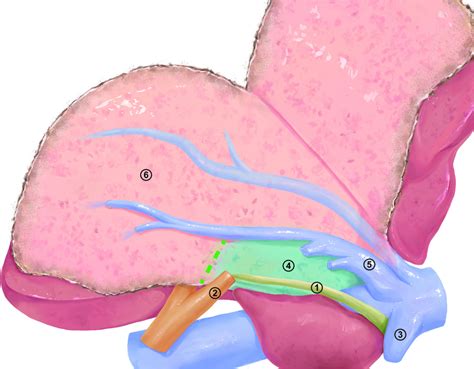 Diagram Of The Surgical Procedure Step 1 Creation Of A Wide Space