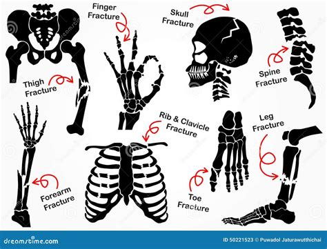 Set Bone Fracture Icon Stock Vector Illustration Of Anatomy 50221523