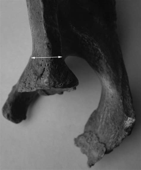 A New Classification Of Glenoid Bone Loss To Help Plan The Implantation