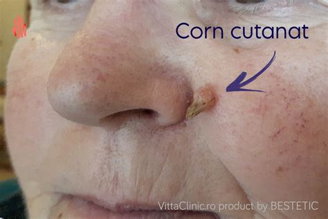 Cornul Cutanat 👉 Ce Este Cauze și Tratament Vitta Clinic
