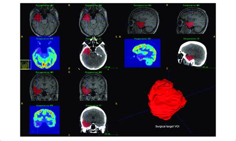 Illustration Of Surgical Target Brain Volume Of Interest Voi