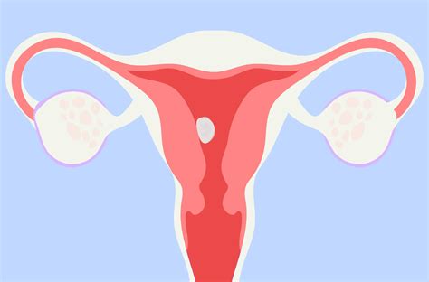When To Start Progesterone To Prevent Miscarriage