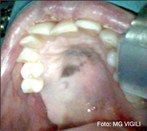 Melanoma Della Mucosa Del Cavo Orale Maurizio G Vigili
