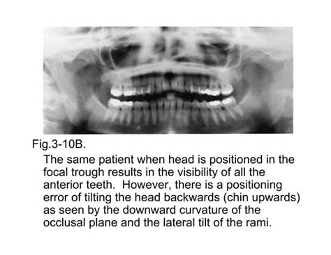 Positioning Errors In Panoramic Radiography PPT