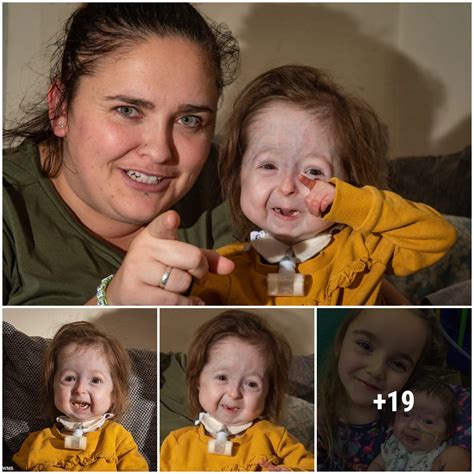 Unveiling Wonder The Charismatic Journey Of A 2 Year Old With A Rare