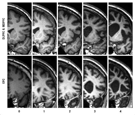 Shows The Array Of Mri Reference Images And Rating Criteria Employed In Download Scientific