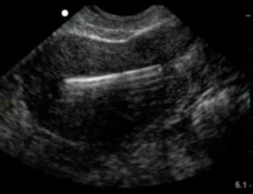 Mirena Ultrasound Appearance