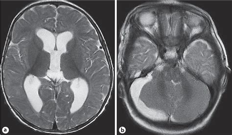 Occipital Dislocation Fracture My Xxx Hot Girl