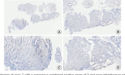 Figure 5 From Interpretation Of Pd L1 Expression In Gastric Cancer Summary Of A Consensus