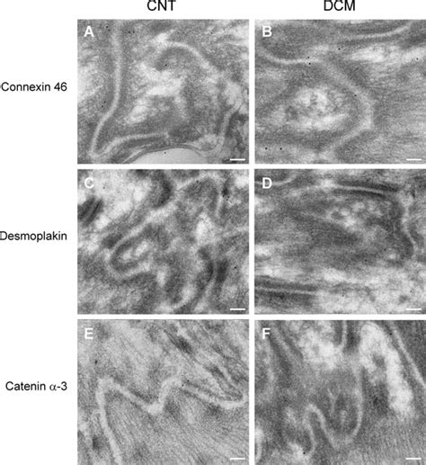 Dilated Cardiomyopathy Plos One
