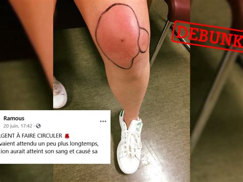 Bug Bite Swelling Foot