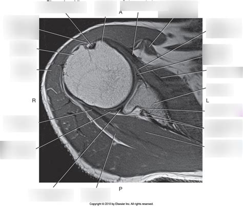 Full Axial T1 Of Glenoid Labrum Shoulder Diagram Quizlet