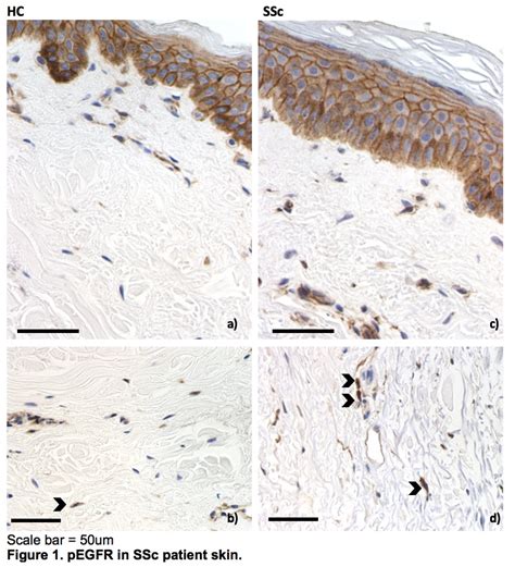 Epidermal Growth Factor Receptor Pathway And Fibrosis In Systemic