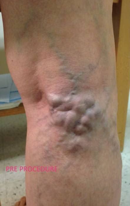 Microphlebectomy Leg Vein Chesapeake Vein Center And Medspa