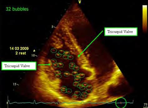 Figure 3 From Ultrasound For Bubble Detection Toward Automated Bubble Counts From 2 D