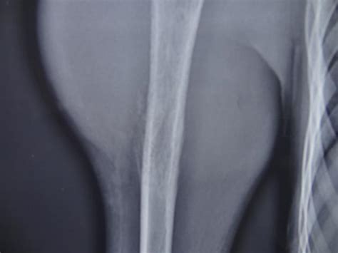 Ewing Sarcoma Of The Humerus Pacs