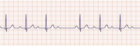 Ecg Simulator By Aclsmedicaltraining Intensive Care Network