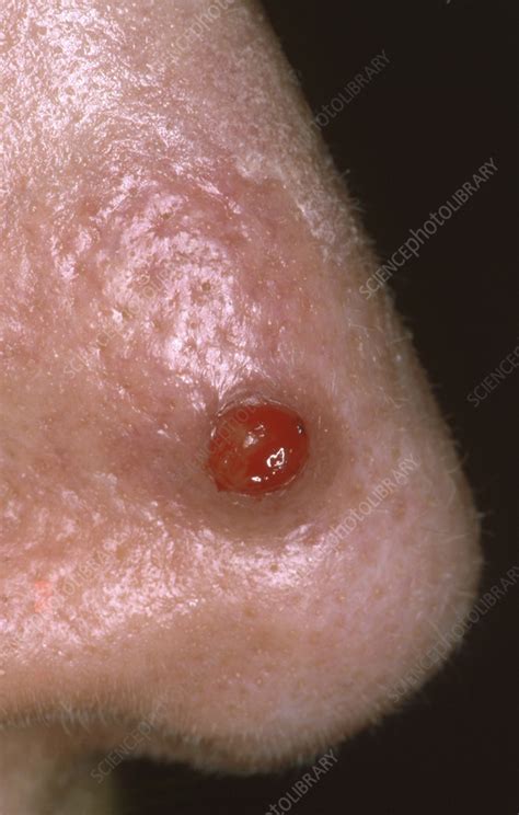 Pyogenic Granuloma On Womans Nose Stock Image C060 2580 Science Photo Library