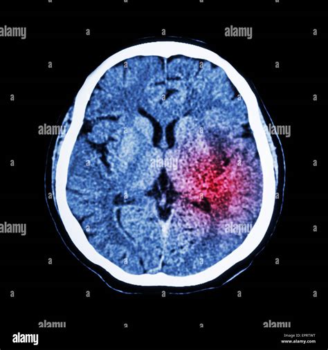 CT Scan Of Brain Show Ischemic Stroke Or Hemorrhagic Stroke Stock Photo Alamy