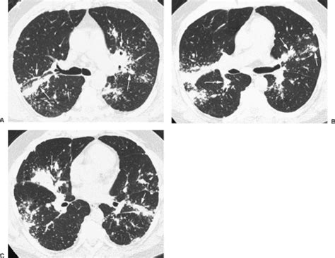 Diffuse Lung Disease Thoracic Key